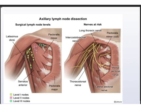 Axillary Lymph Node Dissection Risks Quiz