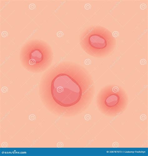 Understanding Type Of Acne A Comprehensive Visual Guide For Everyone Stock Vector Illustration