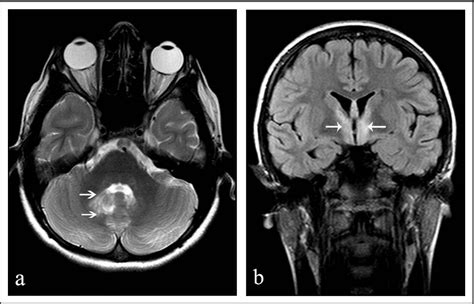 Figure 1 From Unusual Manifestations Of Pediatric Neuromyelitis Optica Semantic Scholar