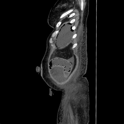 Fileesophageal And Gastric Pneumatosis Portal Venous Gas Radiopaedia