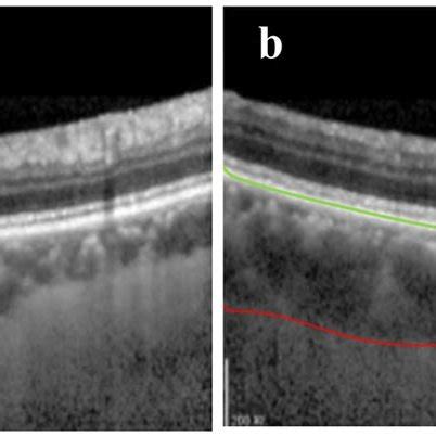 A Represents A Raw B Scan Of The OCT Image B Contains OCT Image Download Scientific