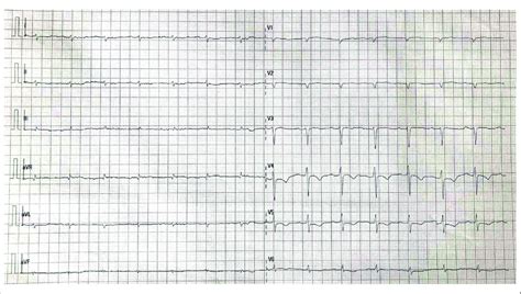 An Electrocardiogram From Patient 1 Showing Microvoltage In The Limb