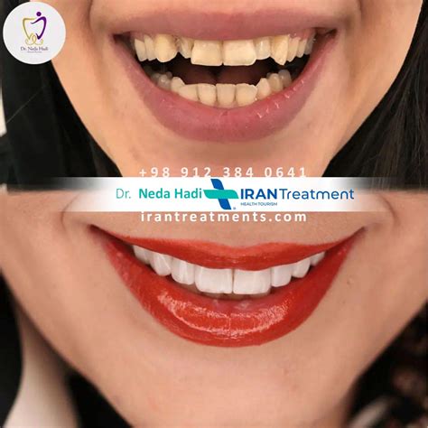 Dental Veneers In Iran Affordable Porcelain Veneers Irantreatments
