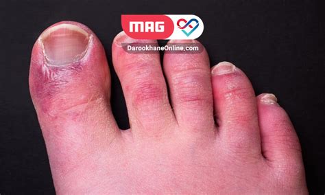 نکروز؛ مرگ بافت بدن