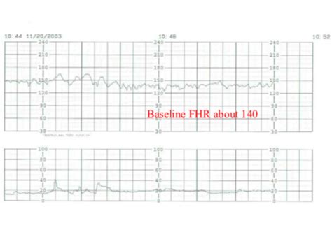 Obstetrics Cardiotocograph Ctg Interpretation Flashcards Quizlet