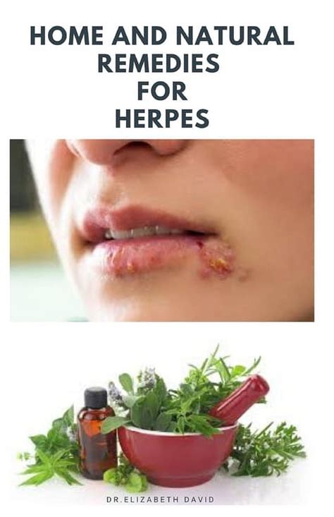 Home And Natural Remedies For Herpes The Best Herbal And Natural