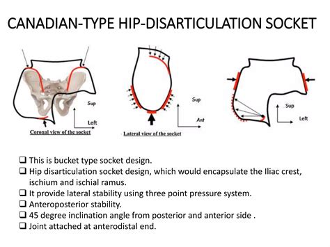 Hip Disarticulation Pptx