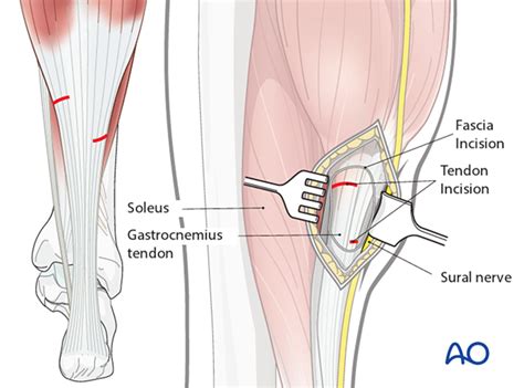 Release Of The Gastrocnemius Equinus