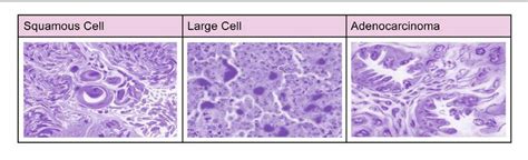 3 Vue Microscopique De Tous Les Types Des Nsclc Download Scientific Diagram