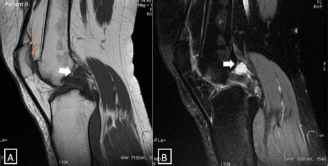 Mri Of The Right Knee Sagittal Mri Slices In T1 Weighted Sequence A
