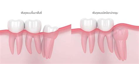 ฟันคุด มีกี่แบบ สรุป ราคา And วิธีเตรียมตัวก่อน หลัง ผ่าฟันคุด Cosdent