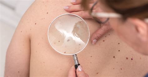 La Inteligencia Artificial Pudo Detectar Casi El 100 De Los Melanomas