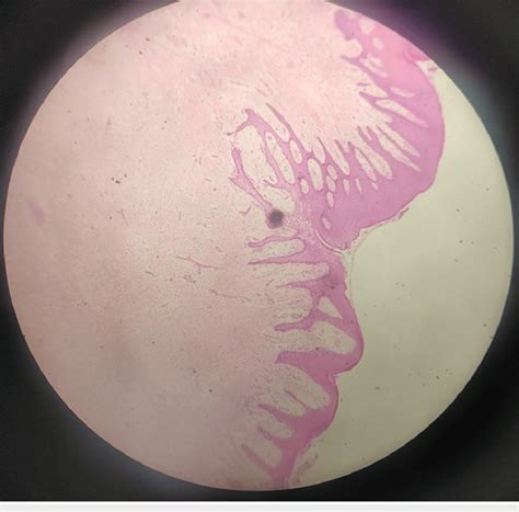 Histopathology Is Suggestive Of Cemento Ossifying Fibroid Epulis Download Scientific Diagram