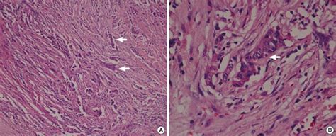 Excision Biopsy Right Breast Lump A Infiltrating Neoplasm Composed