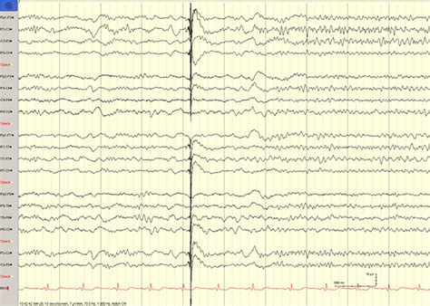 Responsive Neurostimulation Rns Artifact A Novel Eeg Finding