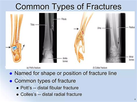 Fracture Its Types And Process Of Bone Healing Ppt