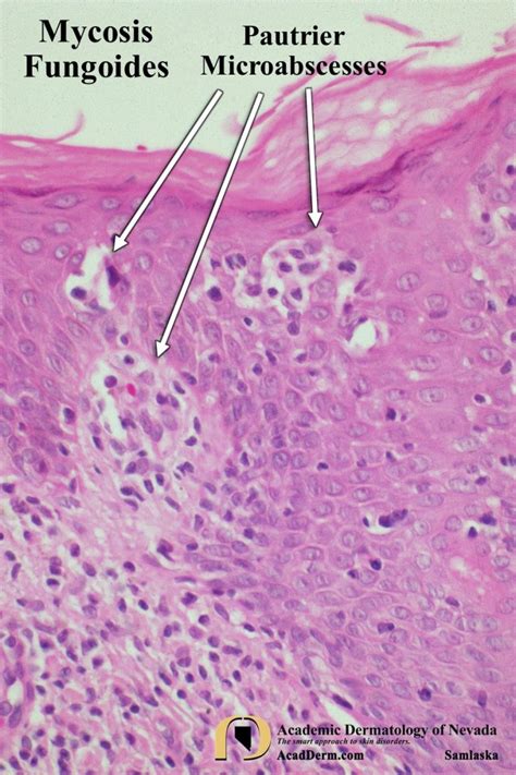 Mycosis Fungoides Cutaneous T Cell Lymphoma Academic Dermatology