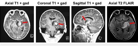 Preoperative Magnetic Resonance Imaging Mri Download Scientific