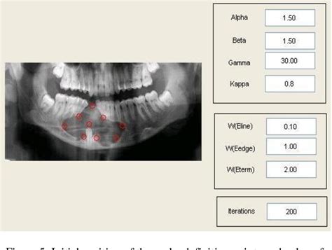 Figure 1 From Cyst And Tumor Lesion Segmentation On Dental Panoramic