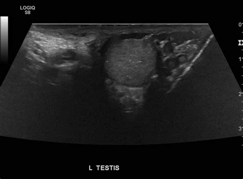 Radiopaedia Case Testicular Seminoma Id 53925 Study 60049 Nc Commons