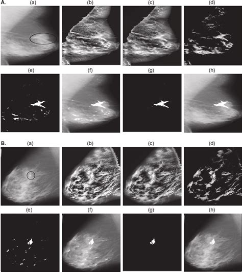Mass Detection Results Of Proposed Algorithm For Mini Mias Images A