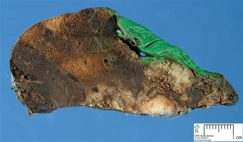 Metastasis Osteosarcoma Metastasis