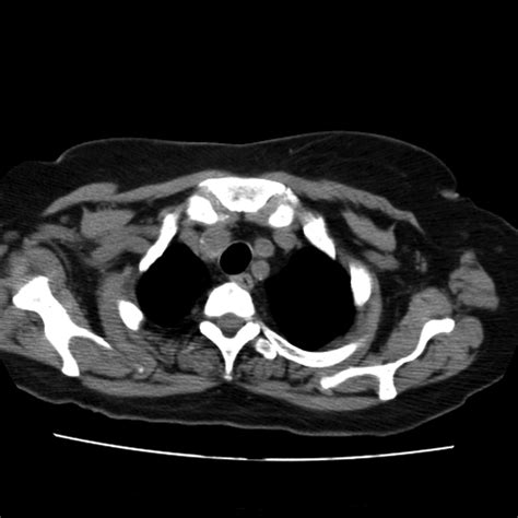 Aortic Arch Pseudoaneurysm Radiopaedia 8534 9368 Axial Non Contrast