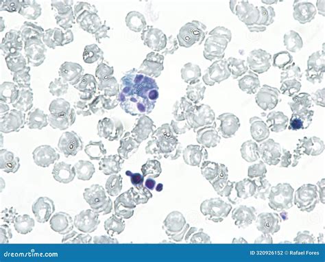 Cryptococcus In Peripheral Blood Smear Gram Stain Royalty Free Stock
