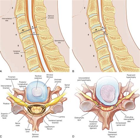 Cervical Spondylotic Myelopathy Clinical Tree
