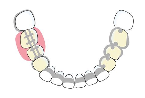 Mandibular Partial Denture