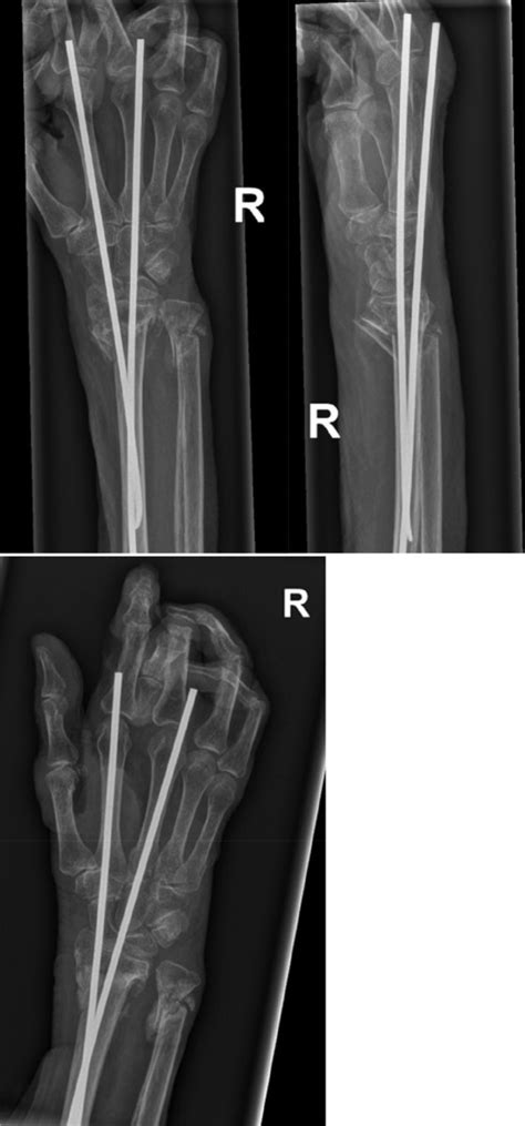 Extra Articular Distal Radius Fractures With Metaphyseal Comminution