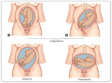 Oblique Position Baby