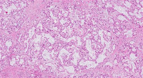 Your Pathology Report For Cholangiocarcinoma Mypathologyreport
