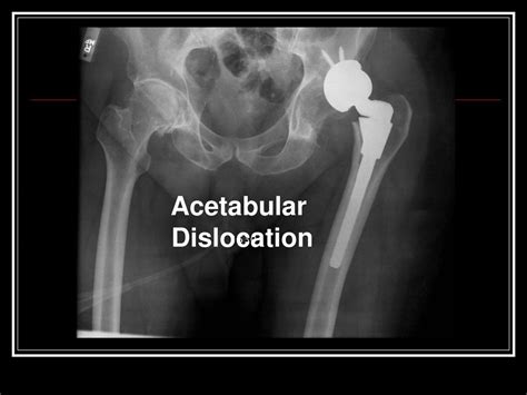 Not Your Average Hip New England Baptist Hospital Sponsored By Lahey Ppt Download