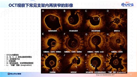师说心语 第二期 尹栋教授： Isr的组织病理学情况和oct影像 师说心语 第二期 尹栋教授： Isr的组织病理学情况和oct影像微冠