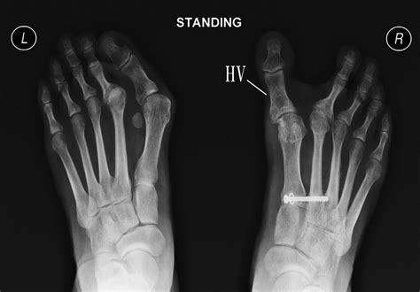 Arthroscopic Arthrodesis Of The First Metatarsophalangeal Joint In
