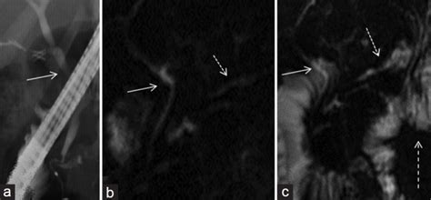A Ercp And Magnetic Resonance Cholangiopancreatography Mrcp Images