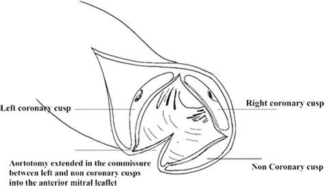 Aortotomy Extension Into Aml For Manouguian Procedure Illustrated By Download Scientific