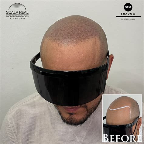Scalp Micropigmentation In Cancun