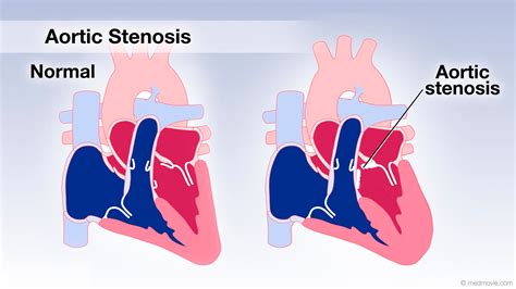 Pulmonary Valve