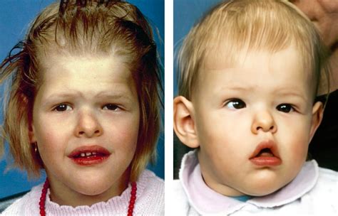 30 Facts About Craniofacial And Skeletal Defects