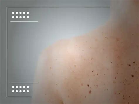 Melanoma Warning Signs Massive Bio