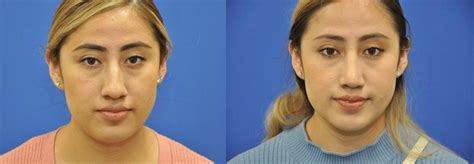 Patient 408504 Rhinoplasty Before And After Photos Mehta Plastic Surgery