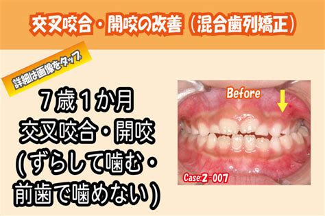 混合歯列 開咬 矯正症例集 みやの矯正・小児歯科クリニック