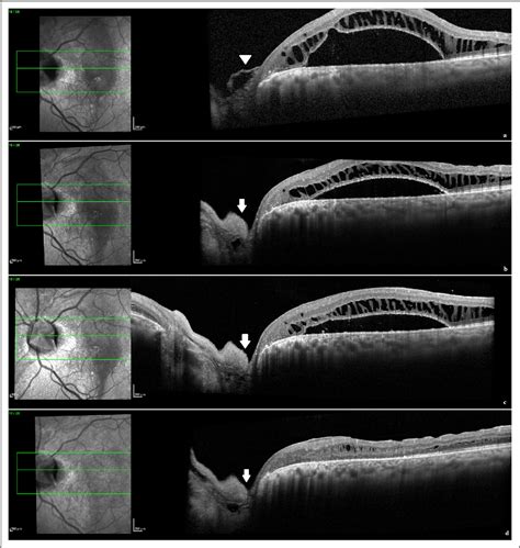 Figure 3 From Management Of Unresolved Optic Disc Pit Maculopathy With