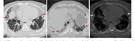 Figure 1 From Diffuse Pulmonary Ossification Associated With Fibrosing Interstitial Lung Disease