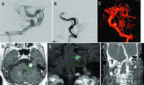 Case 4 A 75 Year Old Patient With A Giant Progressively Symptomatic