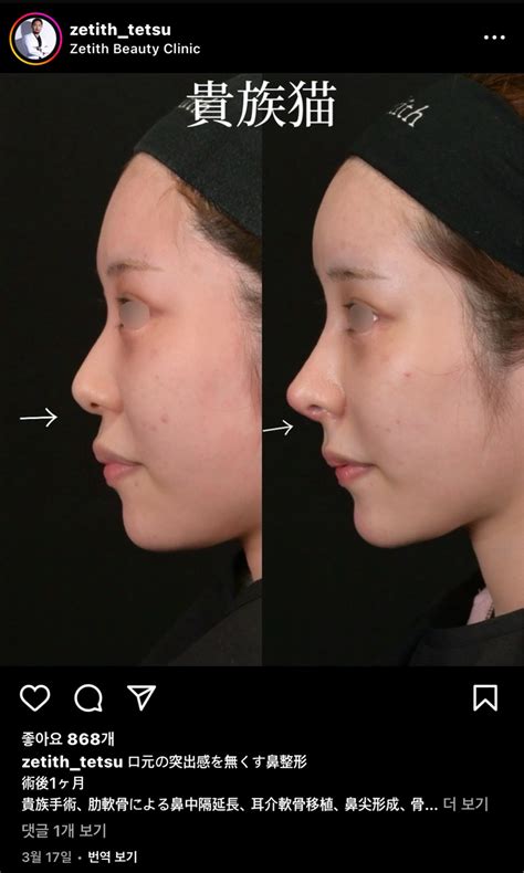 의사에게 물어보세요 비주연장 비순각 강남언니 1등 성형수술and피부시술 정보앱