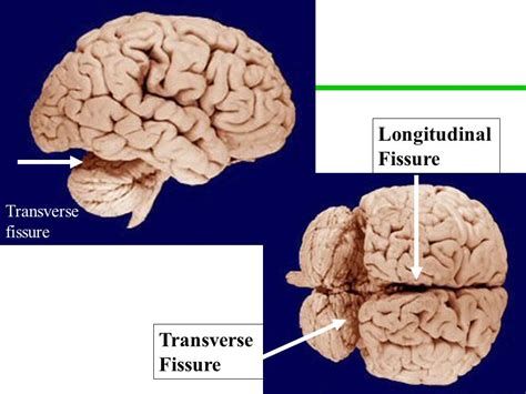 Transverse Fissure Brain