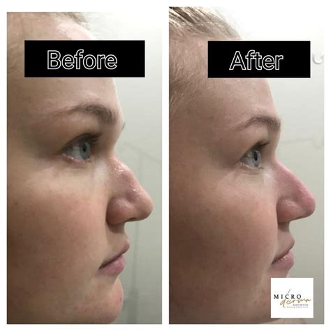 Non Surgical Rhinoplasty Non Surgical Nose Job Only Micro Derma